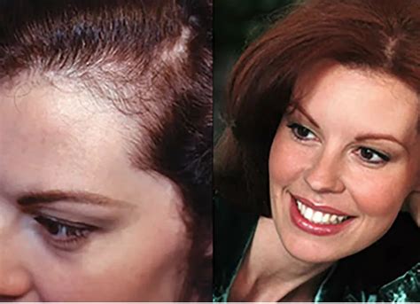 Hair Transplant Before And After Photos Celebrity Men And Women