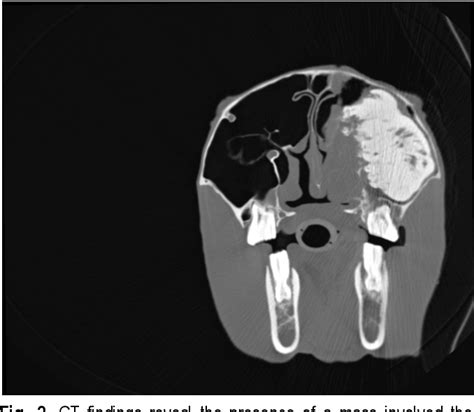 Figure 6 From Parosteal Fibrous Maxillary Osteosarcoma In A Horse A
