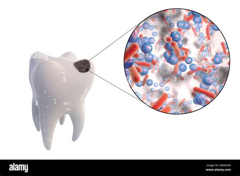 Tooth Decay Computer Artwork Of A Tooth With Cavity And Close Up View
