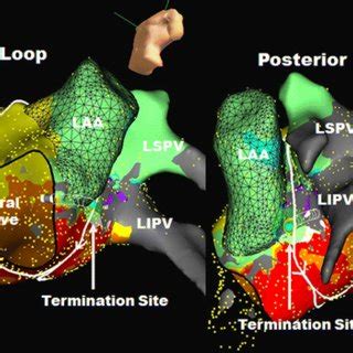 Double Loop Left Atrial Flutter With Anterior Loop Going Clockwise Download Scientific Diagram