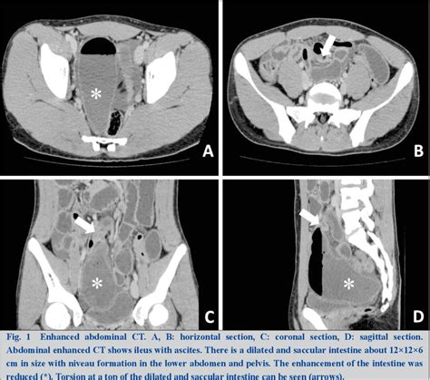Table 1 From Strangulated Ileal Duplication Cyst Caused By Volvulus