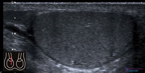 Scrotal Ultrasound