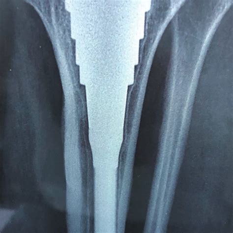 Aori Classification Of Bone Defects In The Femurs Blue And Tibias