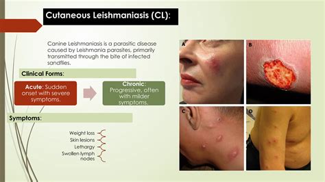 Leishmaniasis Is A Vector Borne Parasitic Disease Pptx