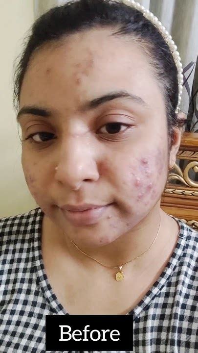 📌isotretinoin এর ৩ মাস Before Vs After Acne Skincare