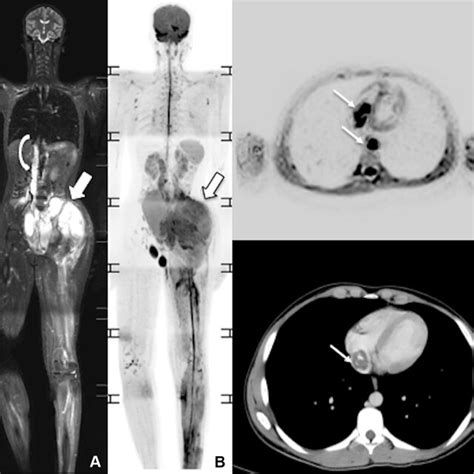 Images In A 10 Year Old Male Patient With A Large Palpable Mass In The