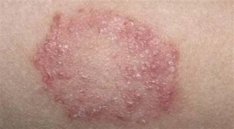 Amalan Untuk Mengatasi Penyakit Kulit Kadas Kurap Dan Lainnya