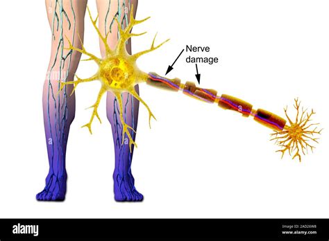 What Causes Diabetic Nerve Pain In Foot At Frances Festa Blog