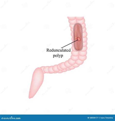 Diverticulitis Vector Illustration Labeled Diagram With Its Structure