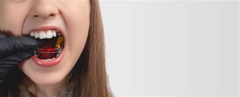 Nottingham Inman Aligner Treatment For Misaligned Front Teeth The