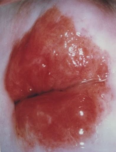 Cervical Cancer Screening Unaided Visual Inspection Of The Cervix Saloney Nazeer