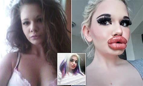 Lip Injections Artofit