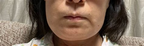 舌癌手術直後と半年経過の今の顔のむくみについて 舌癌ステージ4の診断からの闘病生活など