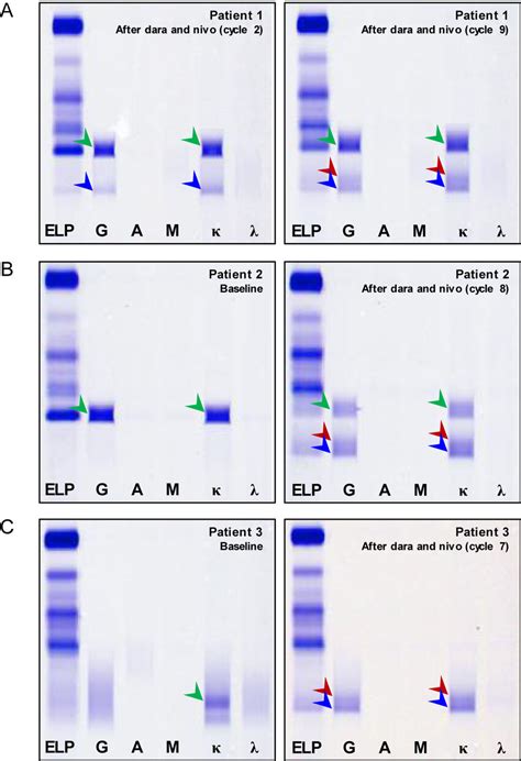 Immunofixation Serum Interpretation Mm