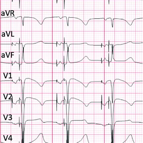 Electrocardiogram Demonstrates Selective His Bundle Pacing 18 Months Download Scientific