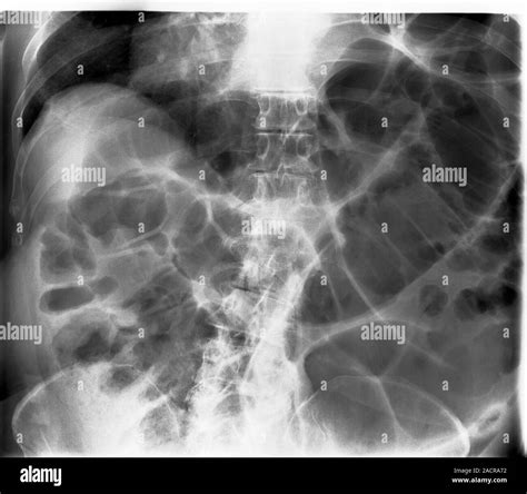 Large Bowel Obstruction X Ray Of The Abdomen Of A Patient With An