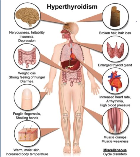 Okay Heres A Simple Explanation Of Hyperthyroidism What Is