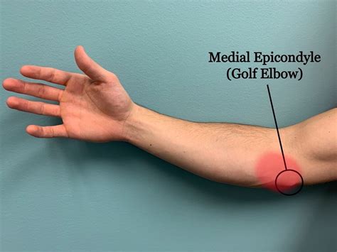 Tennis Elbow