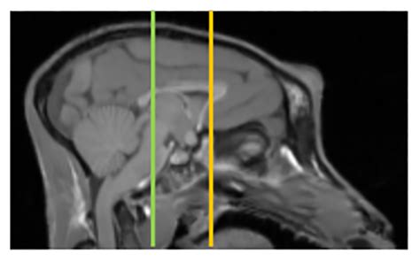 An Example Of How Anterior Cingulate Cortex And Posterior Cingulate