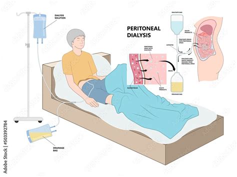 Dialysate Cleansing Home Care Tube Fluid Drain Bag Waste High Blood