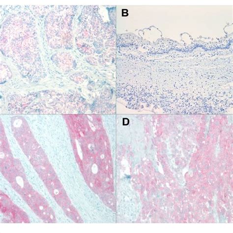 Scc Of The Gingiva Frequently Presents With A Granular Appearance Arrow Download Scientific