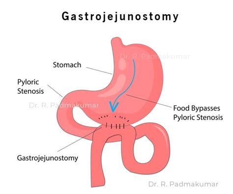 Gastrojejunostomy What Is Laparoscopic Gastrojejunostomy