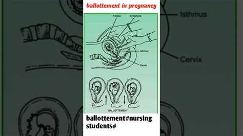 Ballottement During Pregnancy