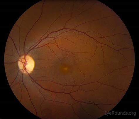 Pattern Dystrophy