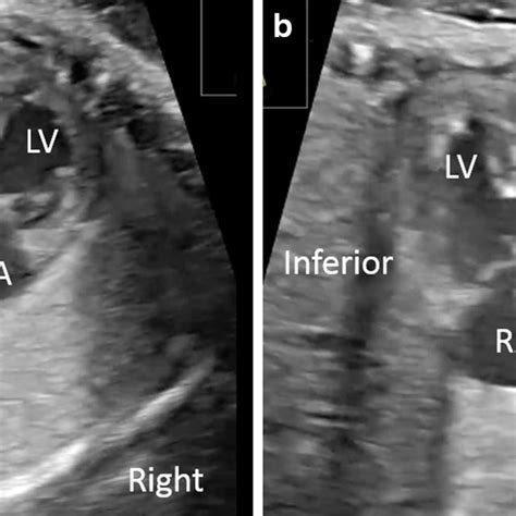 Two Dimensional Fetal Echocardiography At 30 Weeks Of Gestation A The