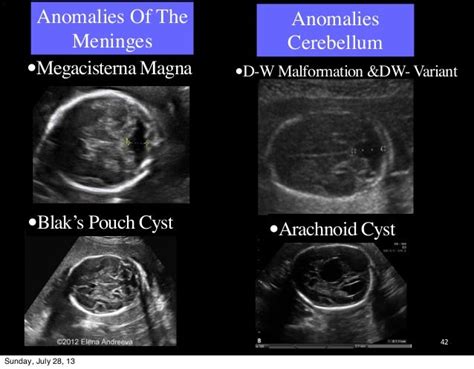 Abnormal Cerebellum Fetal Ultrasound
