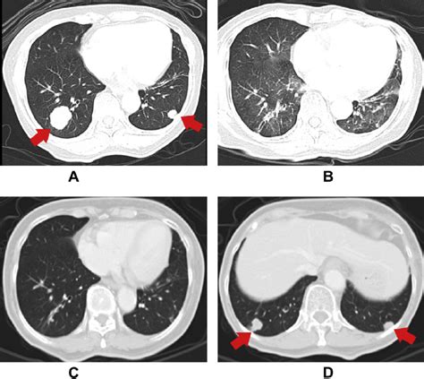 Contrast Enhanced Chest Computed Tomography Ct 2 5 Years After