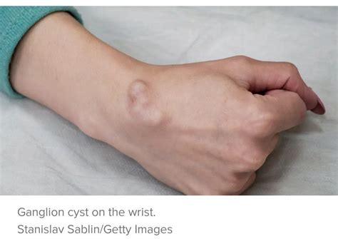 Extensor Retinaculum Of Hand