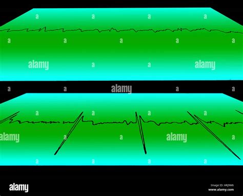 Atrial Flutter Normal Heart Beat Stock Photo Alamy