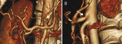 Celiac Artery Compression Syndrome Causes Symptoms Diagnosis