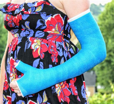 Full Arm Spica Cast For Scaphoid Fracture Broken Arm Cast It Cast