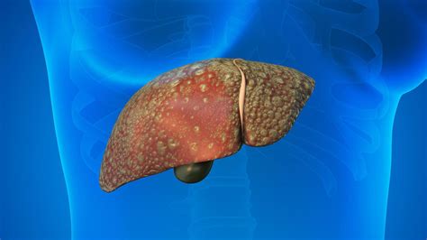 Steatotic Liver Disease Gender Disparity In Serious Outcomes World
