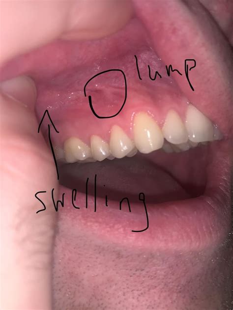 Hard Bony Lump On Upper Gum Swelling Nearby Already Been To A
