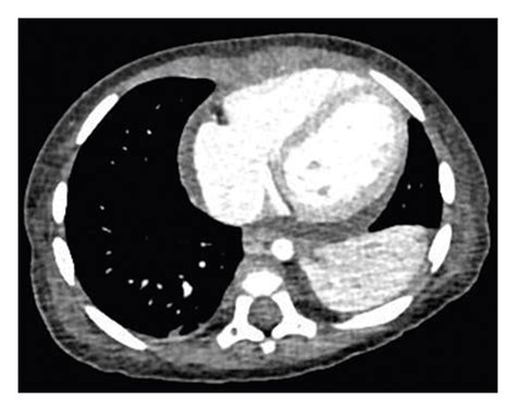 Contrast Enhanced Computed Tomography Scan Of The Chest Showing A