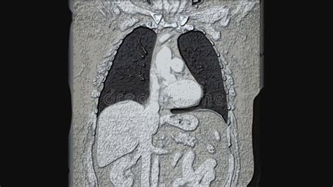 Mri De Color Voluminoso De Los Pulmones Y Diagnóstico Bronchi De