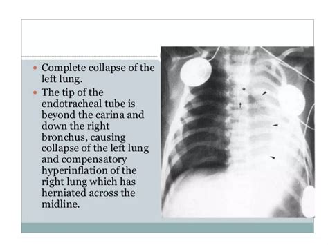 Collapse And Consolidation Lung Radiology Ppt