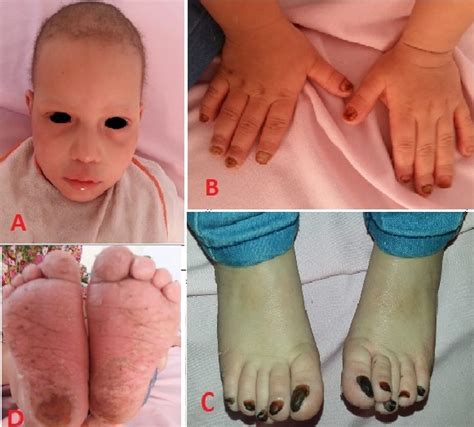 Ectodermal Dysplasia Wikipedia Hypohidrotic Ectodermal Dysplasia Gene Reviews