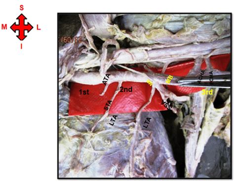 Illustration Showing Subscapular Artery And Thoracodorsal Artery Download Scientific Diagram