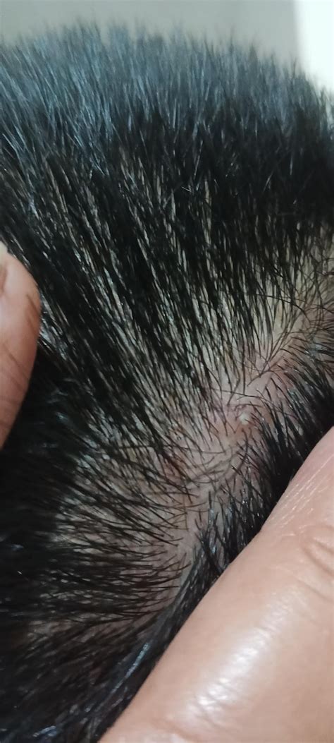 Do I Have Scalp Folliculitis I Have Bumpspimples And Redmarks Its