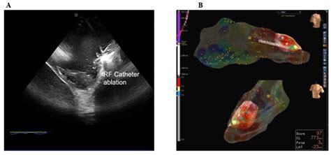 Benefit Of The Combined Use Of Three Dimension Anatomical Mapping And Intracardiac