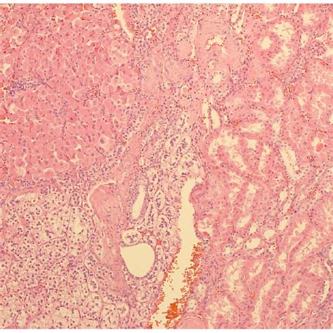 Histopathology Section Showing Diffuse Proliferation Of Oncocytes