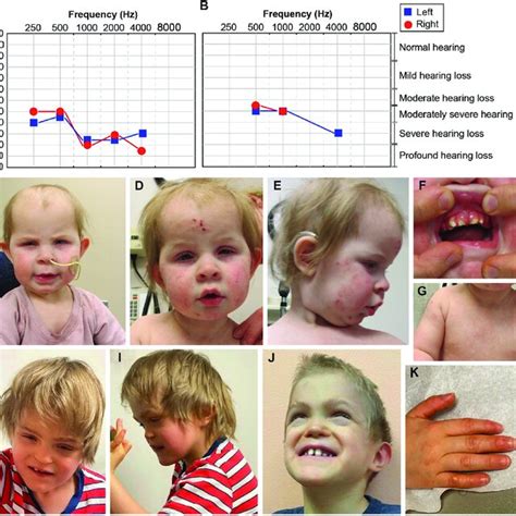 Clinical Phenotypes Of Proband 1 And 2 A Proband 1s Vra Test