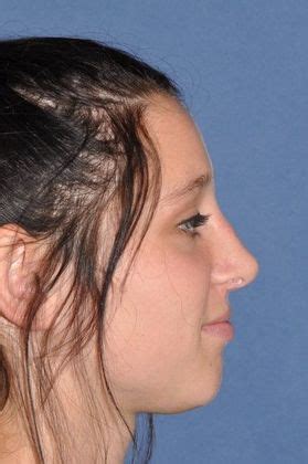 Revision Rhinoplasty For Breathing And Appearance Rhinoplasty Before And After Gallery