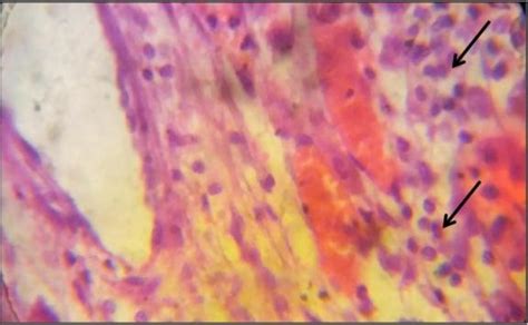 Section Of Liver Of Hydatid Cyst Infected Goat Showing Infiltration Of