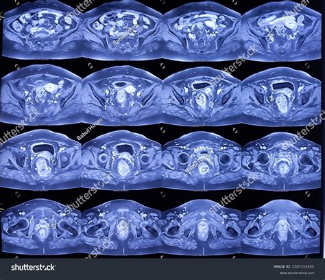 Mri Magnetic Resonance Imaging Scan Pelvis Stock Photo Shutterstock