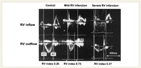 Pseudonormalization Of The Right Ventricular Tei Index Representative Download Scientific